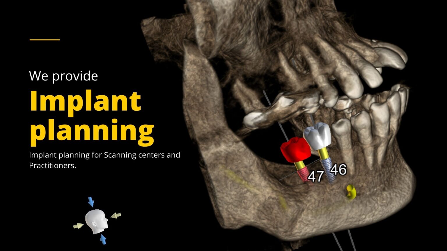Streamlining Dental Implant Reporting with Radix Renders & Diagnostics ...